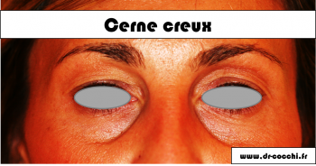 Traitement cernes, vallée des larmes. Peeling, acide hayluronique la ...